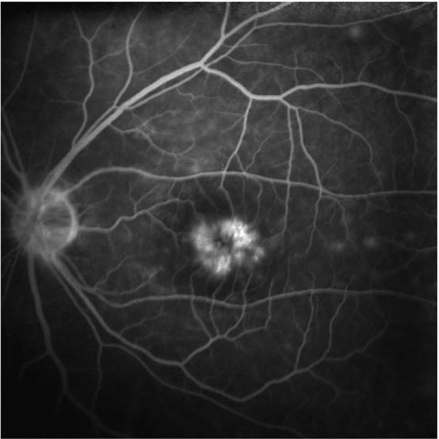 Get Much Needed Information on Cystoid Macular Edema