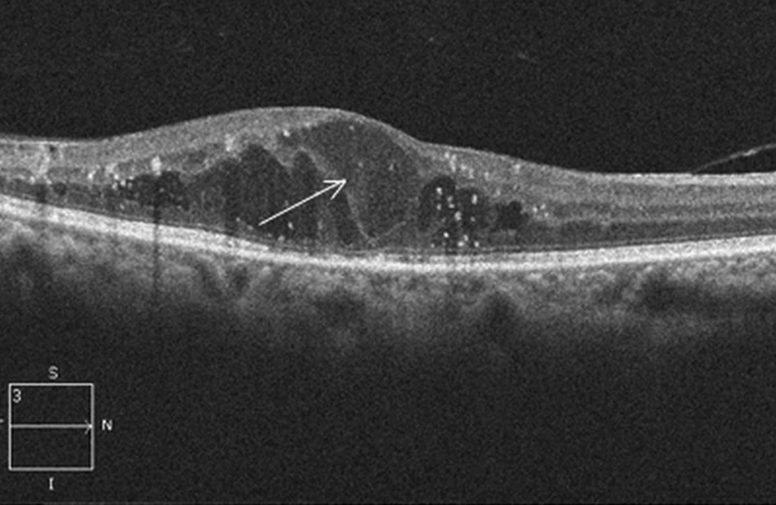 Understand the Four Stages of Diabetic Retinopathy