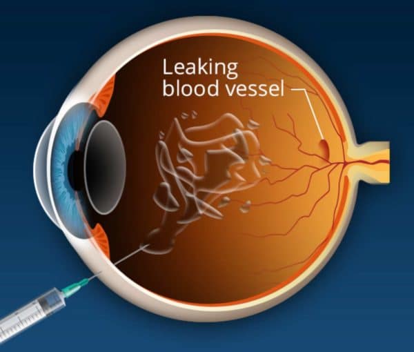 Intravitreal Injections 101: What You Need To Know