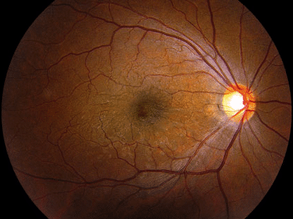 Macular Edema Treatment in Sarasota | Shane Retina